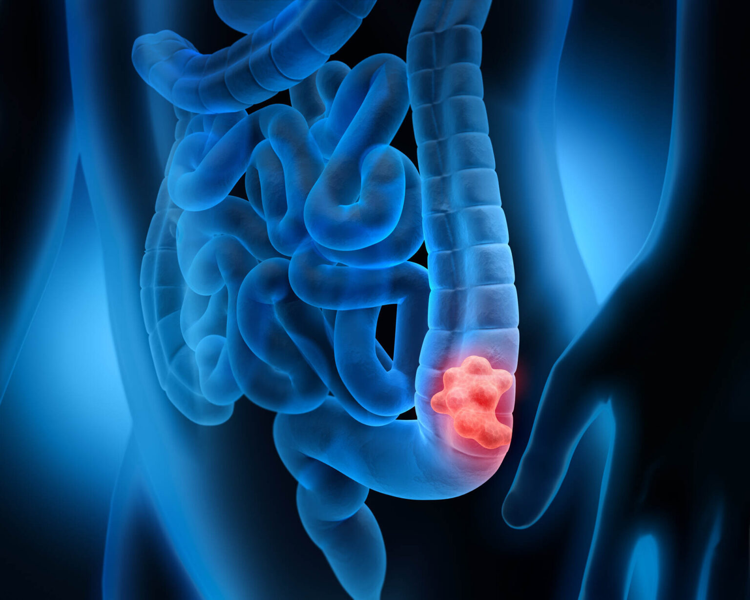 Colonoscopy – Cancer A-Z