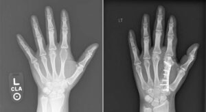 X-rays – Cancer A-Z
