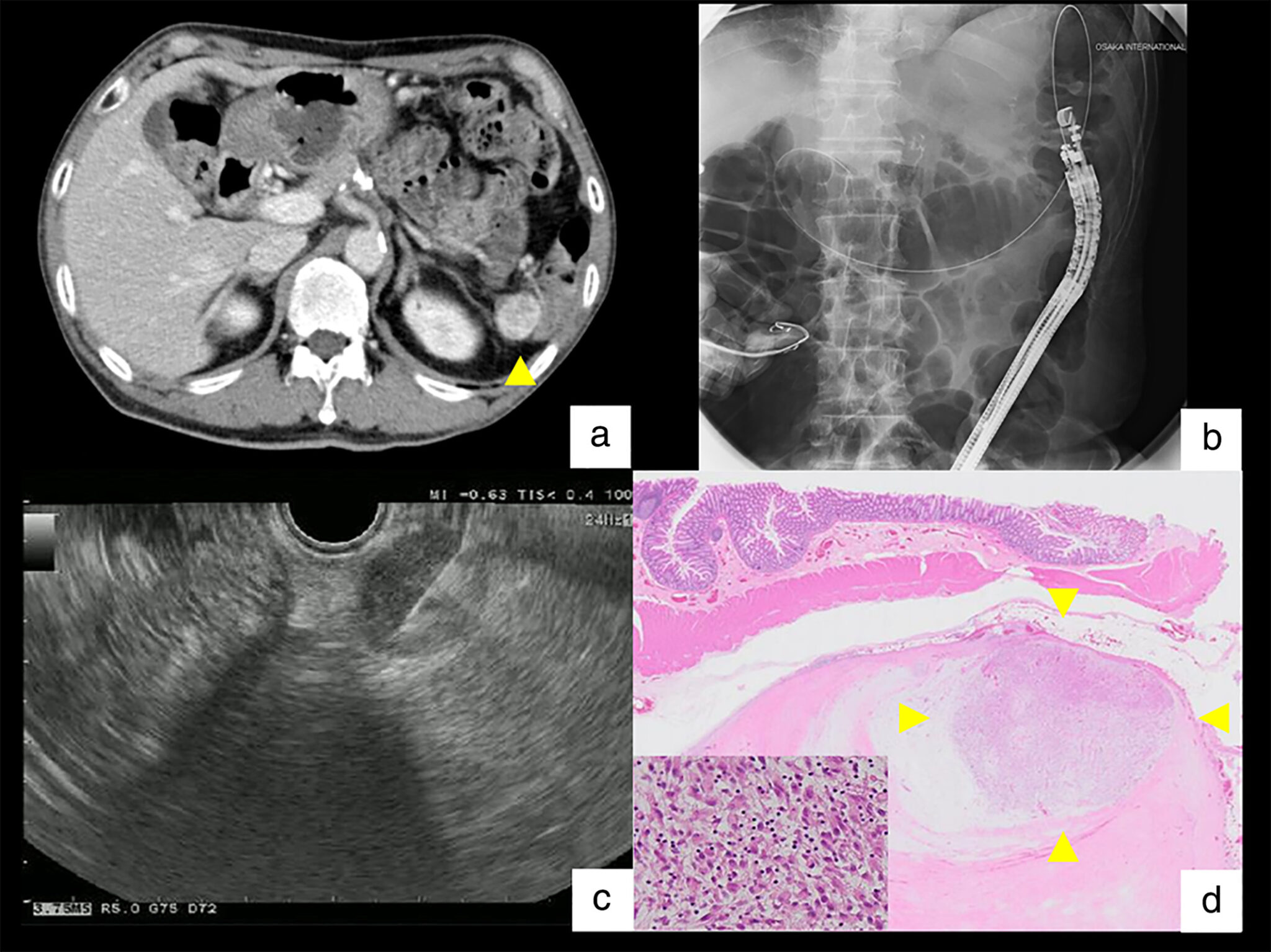 Malignant Fibrous Histiocytoma (Undifferentiated Pleomorphic Sarcoma ...