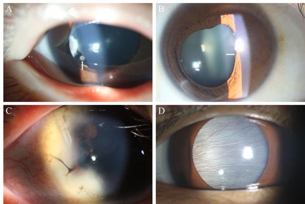 Medulloepithelioma (Intraocular, Rare) – Cancer A-Z
