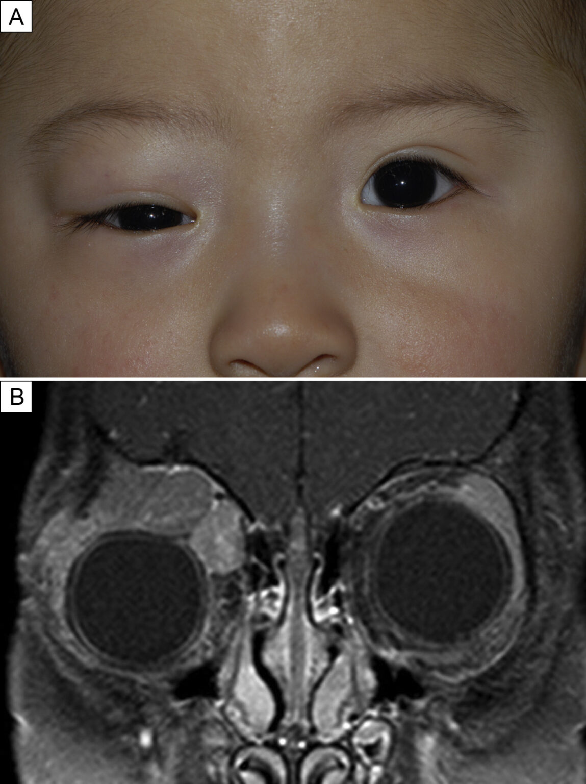 Rhabdomyosarcoma (Orbital Subtype) – Cancer A-Z