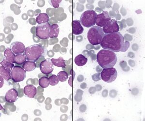 Leukemia (ALL, AML, CLL, CML) – Cancer A-Z