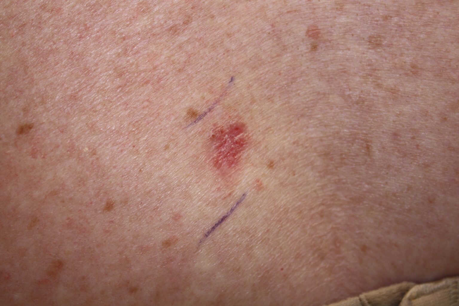 Basal Cell Carcinoma (BCC) – Cancer A-Z