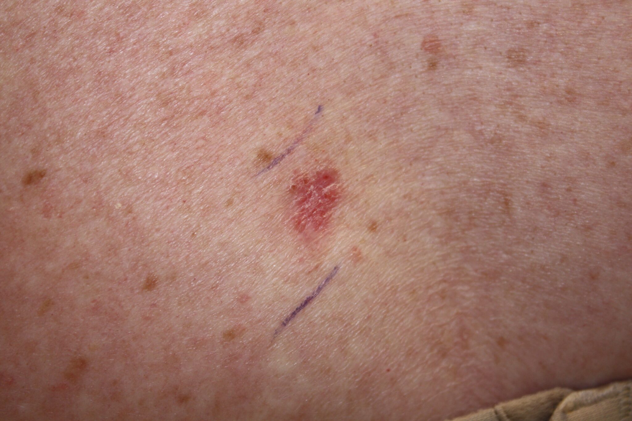 Basal Cell Carcinoma (BCC) – Cancer A-Z