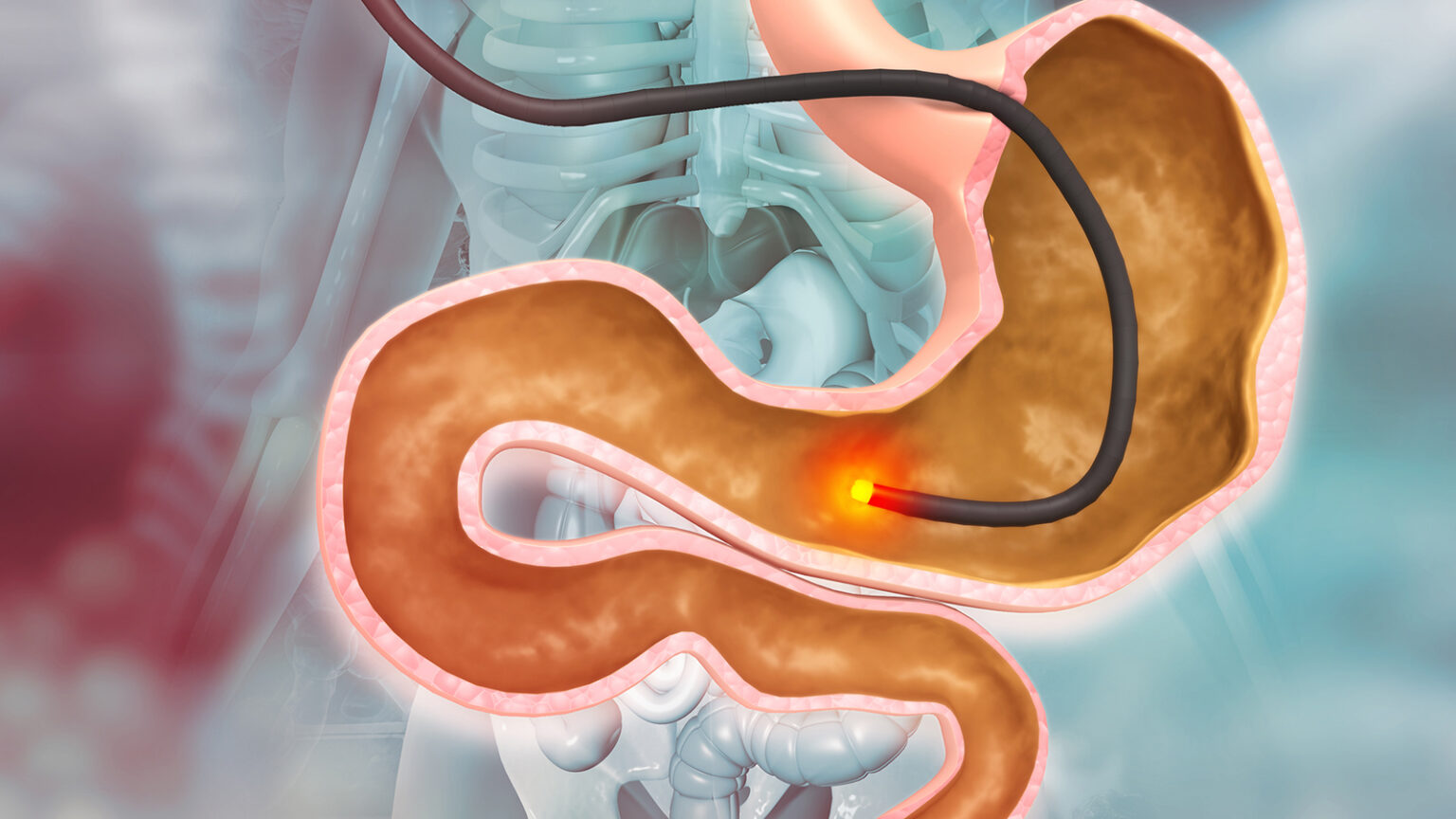 Endoscopy – Cancer A-Z